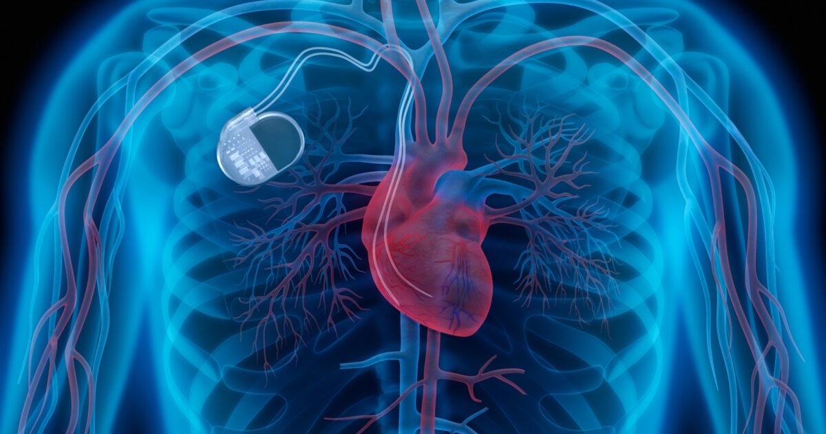 Wireless communication for implanted wireless sensors | AntennaWare